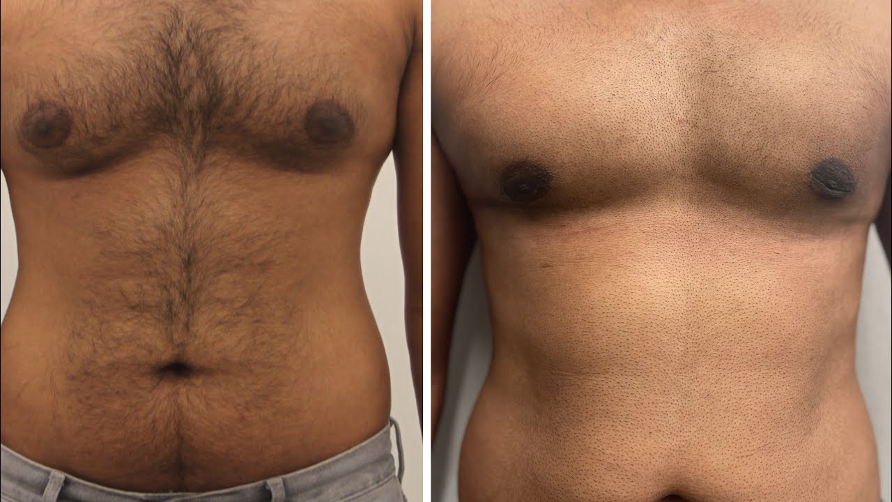 Gynecomastia and Male Chest Contouring with Vaser Liposuction and ...