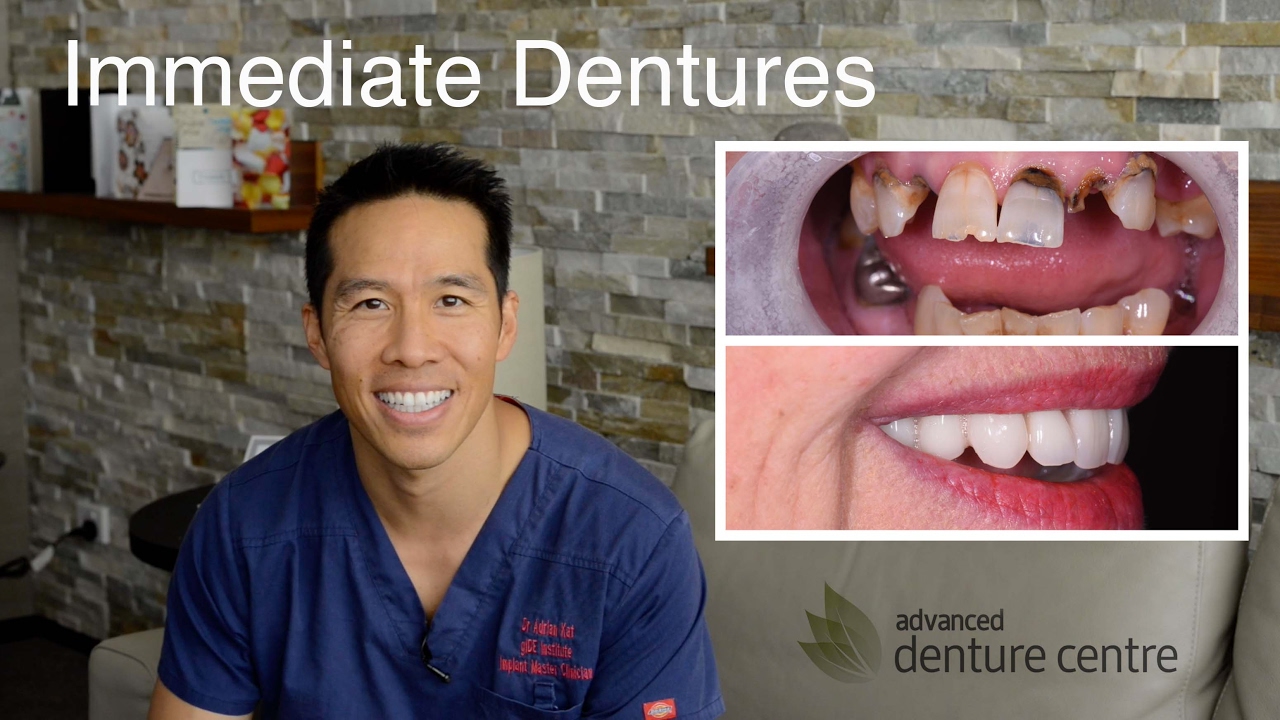 Immediate Dentures! From terminal teeth to beautiful smile - YouTube