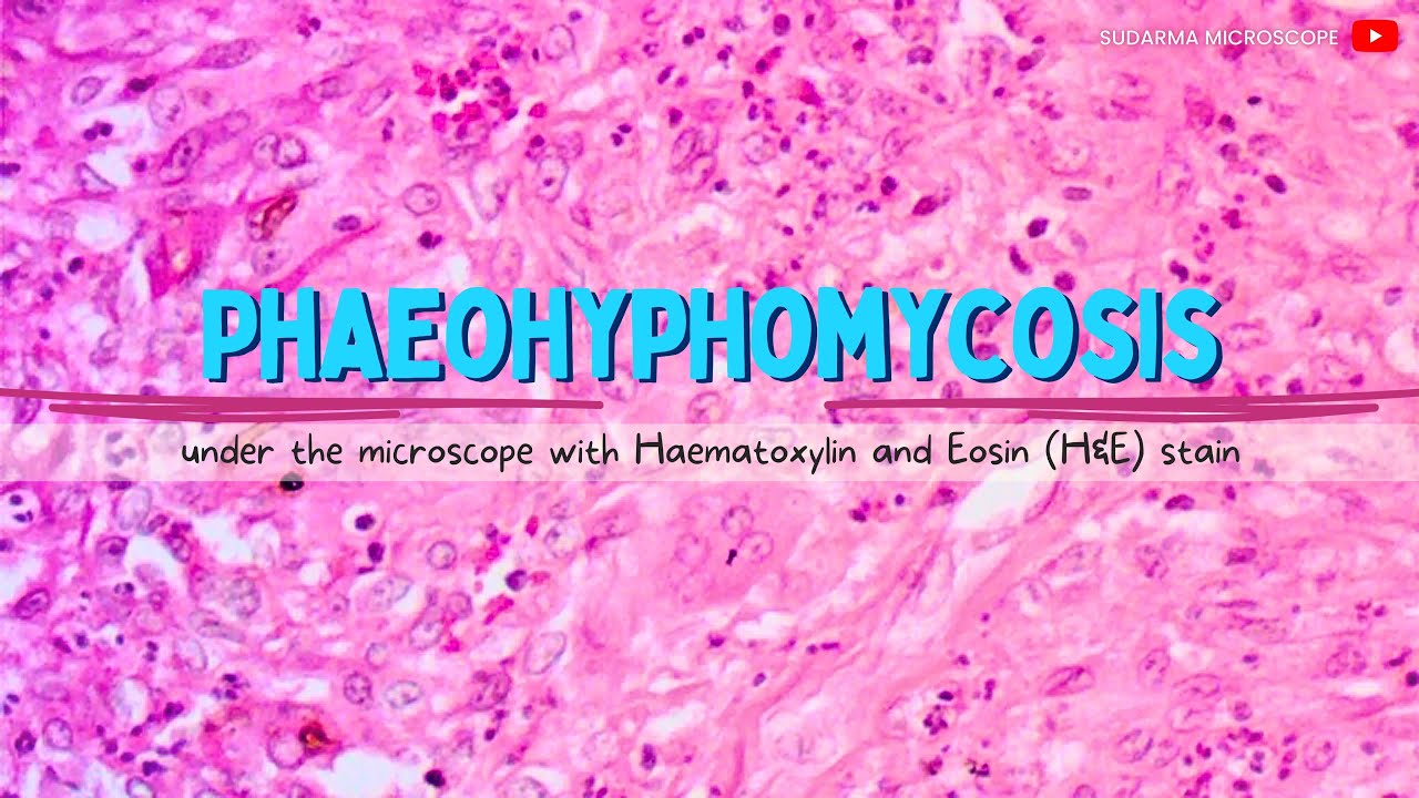 Phaeohyphomycosis under the microscope with Haematoxylin and Eosin (H&E ...