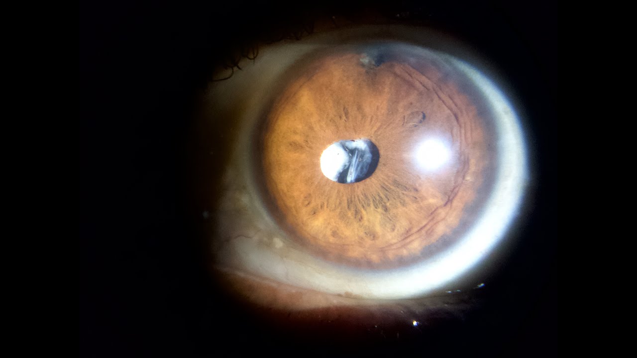 VITRECTOMY FOR OLD TRAUMATIC PARTIALLY ABSORBED CATARACT WITH IRIS CLAW ...