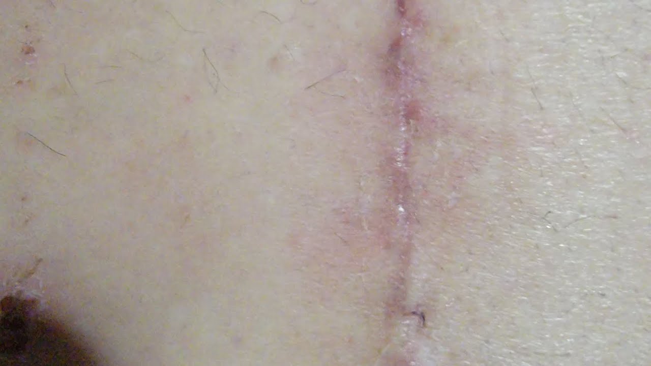 PLIF Surgery L4 L5 Fusion Recovery 1 month update. - YouTube