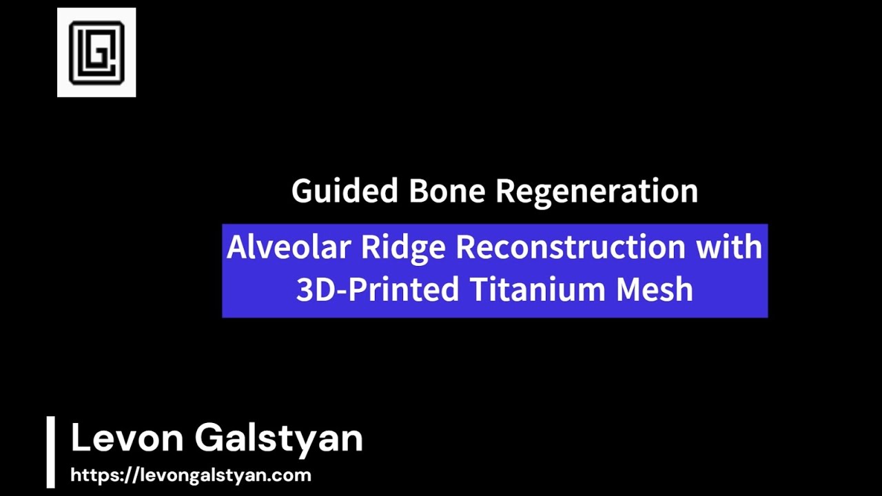 Guided Bone Regeneration: Alveolar Ridge Reconstruction with 3D-Printed ...