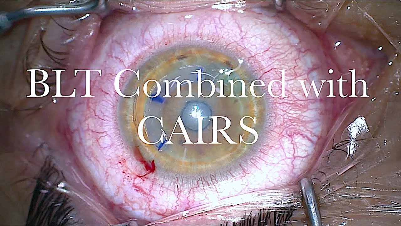 A Novel Technique of Combining Bowman Layer Transplantation with CAIRS ...