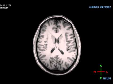 Axial view of my brain - YouTube