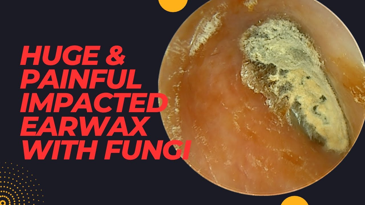 HUGE and PAINFUL Impacted Earwax Covered With Fungi - YouTube