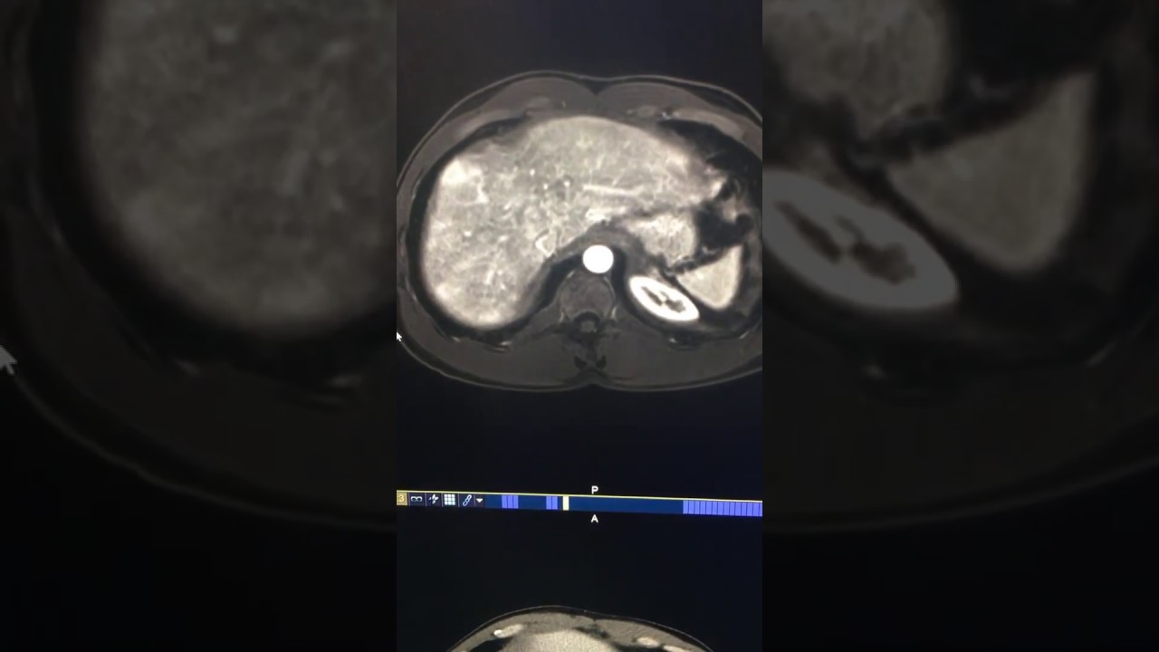 Liver MRI Sequence 2 - YouTube