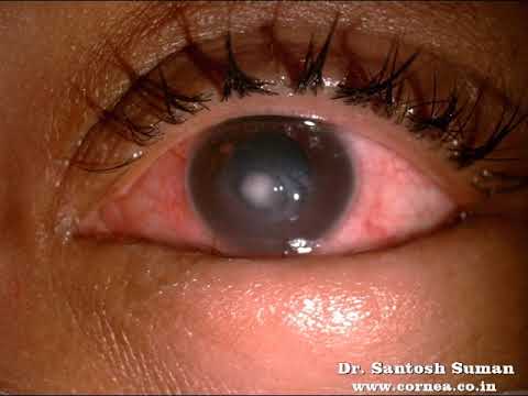 Spastic Entropion in Corneal Ulcer - YouTube