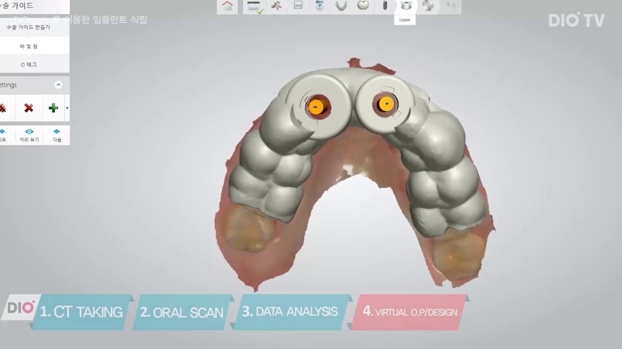 DIO Implant Placement - YouTube