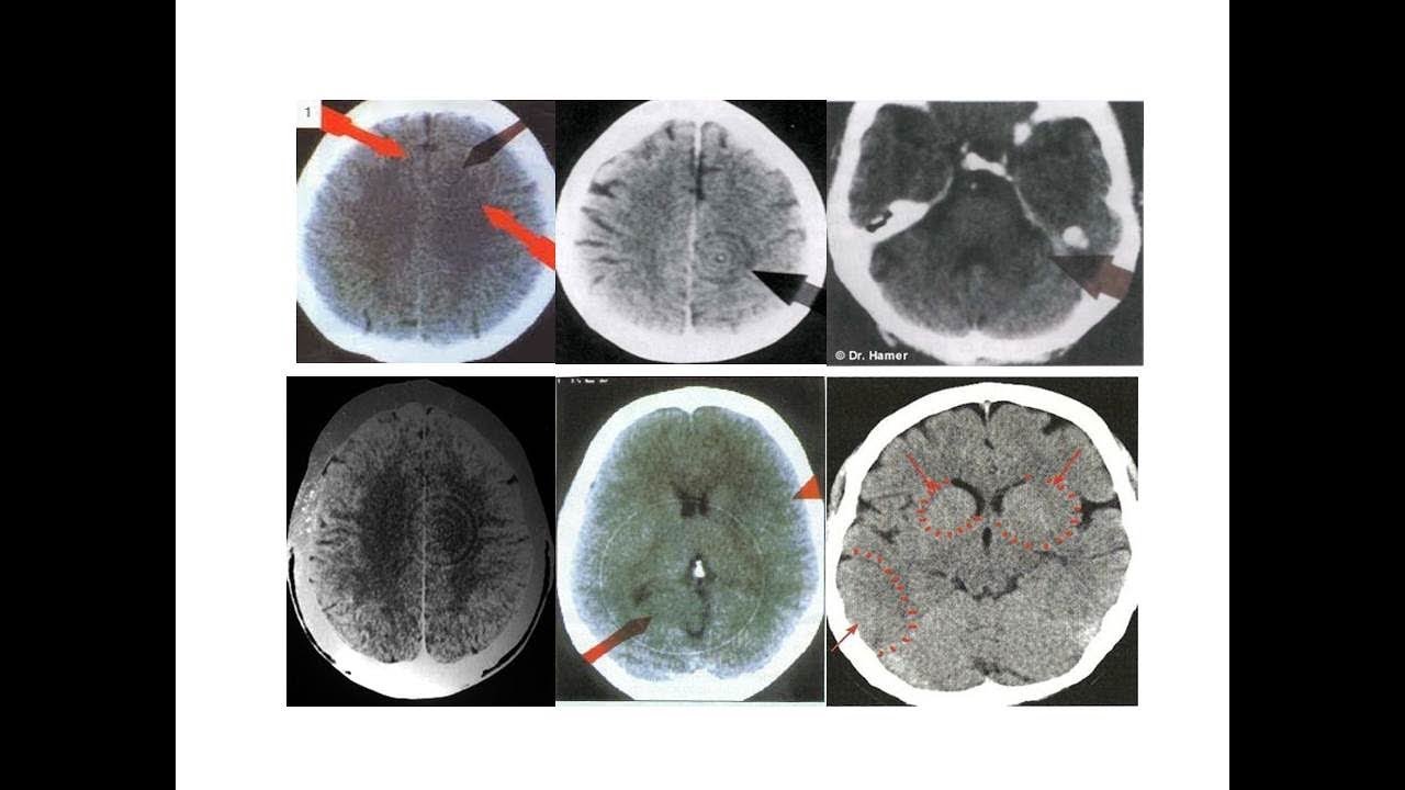 NUEVA MEDICINA GERMÁNICA, FOCOS DE HAMER. - YouTube
