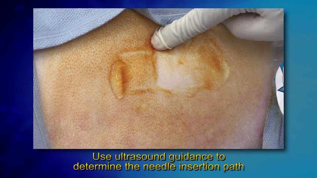 Talimogene Laherparepvec (T-VEC): Intrahepatic Injection Procedures ...