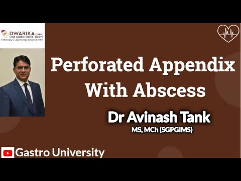 Surgery for Appendicular Abscess with Cavity. Dr Avinash Tank. Dwarika ...