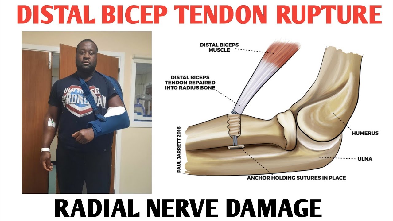 I Ruptured My Distal Bicep Tendon (Recovery & Surgery) - YouTube