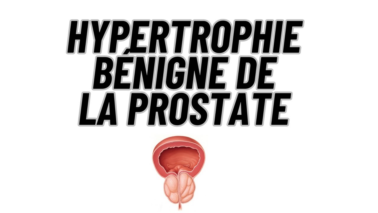 Hypertrophie bénigne de la prostate - YouTube