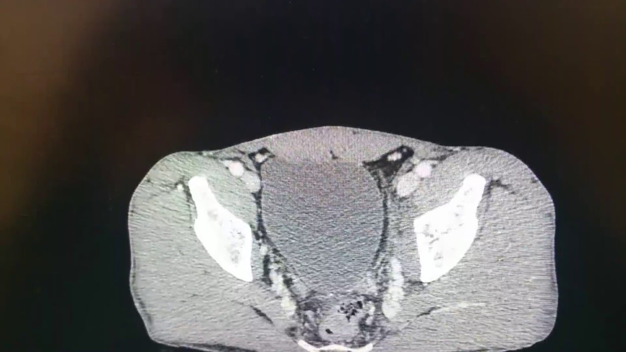 Acetabular fracture abdominal window - YouTube