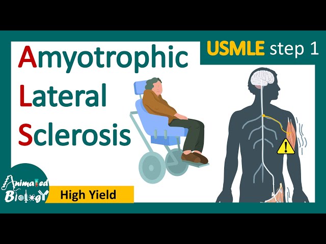 The Stages Of Amyotrophic Lateral Sclerosis Als Als News 47 Off