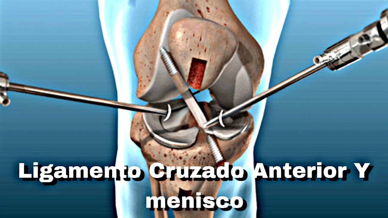 Artroscopia de rodilla // LIGAMENTO CRUZADO ANTERIOR Y MENISCO \\ LCA Y ...