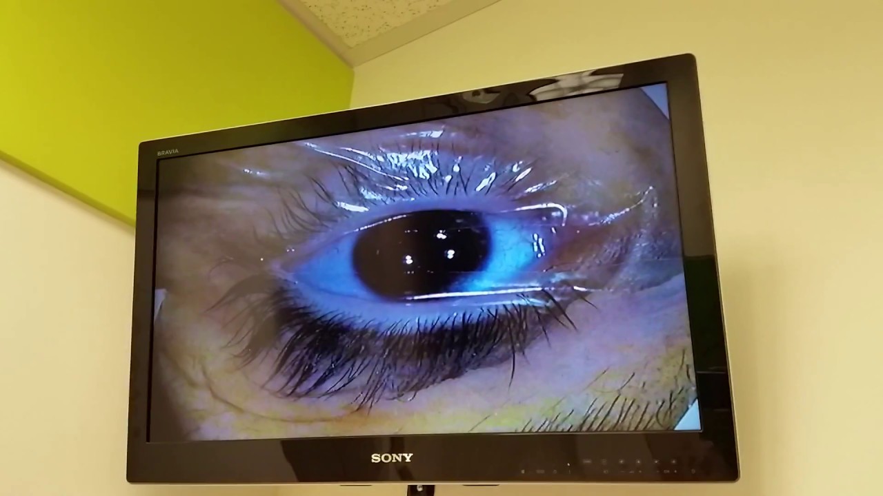Laser Eye Exam Procedure YouTube laser-eye-exam-procedure-youtube