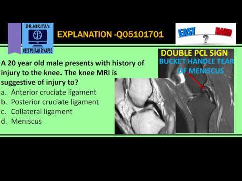 DOUBLE PCL SIGN- MRI KNEE- BUCKET HANDLE TEAR OF MEDIAL MENISCUS - YouTube