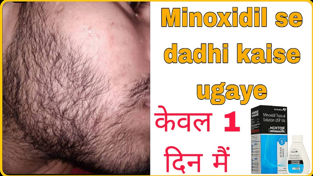 minoxidil se dadhi kaise ugaye | fast beard growth for minoxidil | The ...