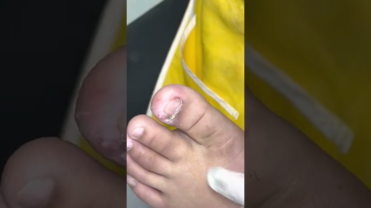 Ep_4248 Ingrown toenail removal 👣 แหลมไหมคะ? 😁 (clip from Thailand ...