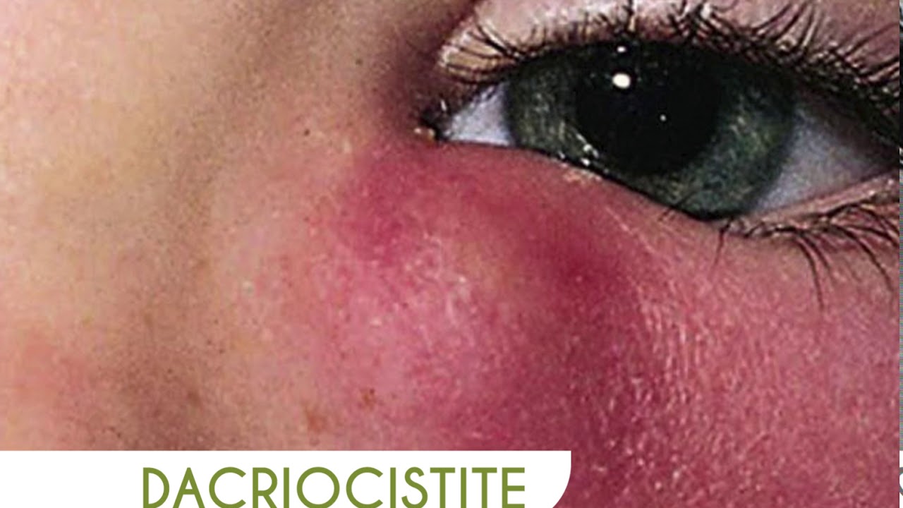 DACRIOCISTITE | HOSPITAL DE OLHOS VELLOSO - YouTube