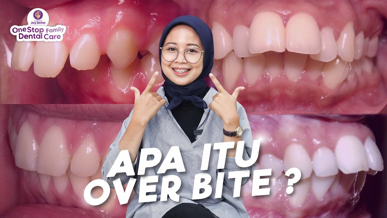 APA ITU OVER BITE ? GIGI DEPAN MAJU DAN BAGAIMANA MENGOBATI OVER BITE ...