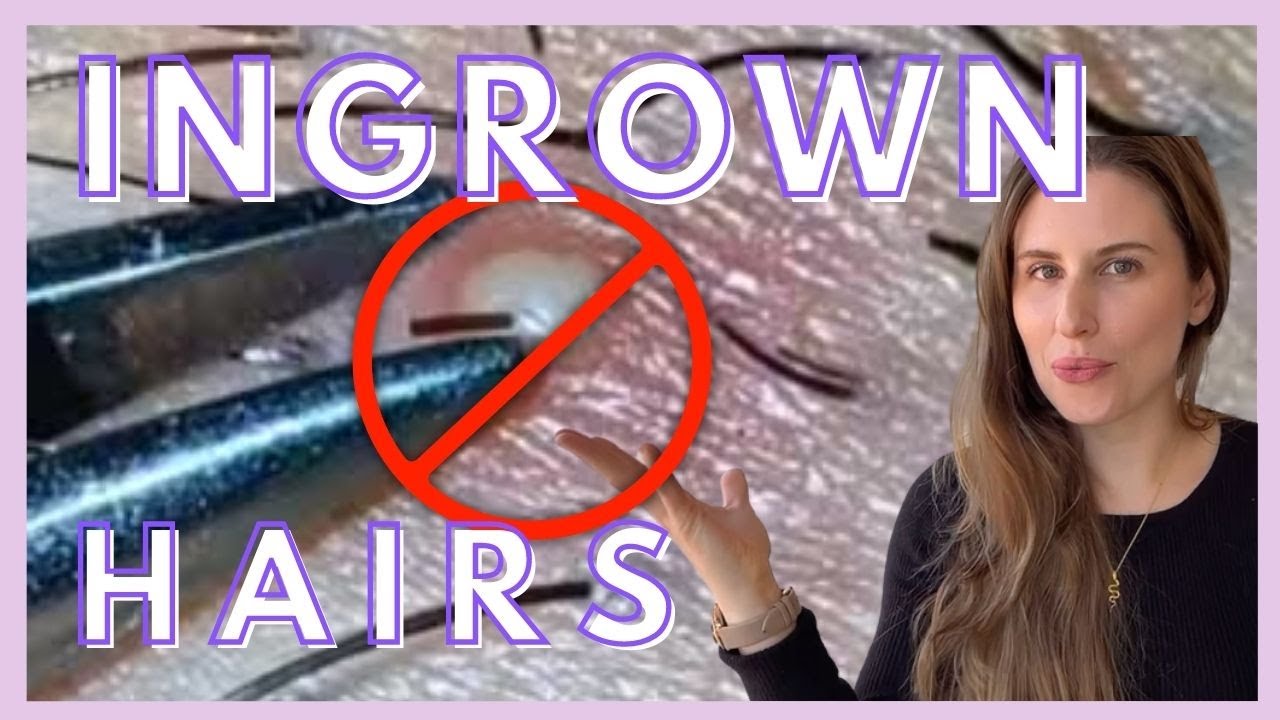 TREAT AND PREVENT INGROWN HAIRS! Doctor Tips To Fix Ingrown Hairs - YouTube