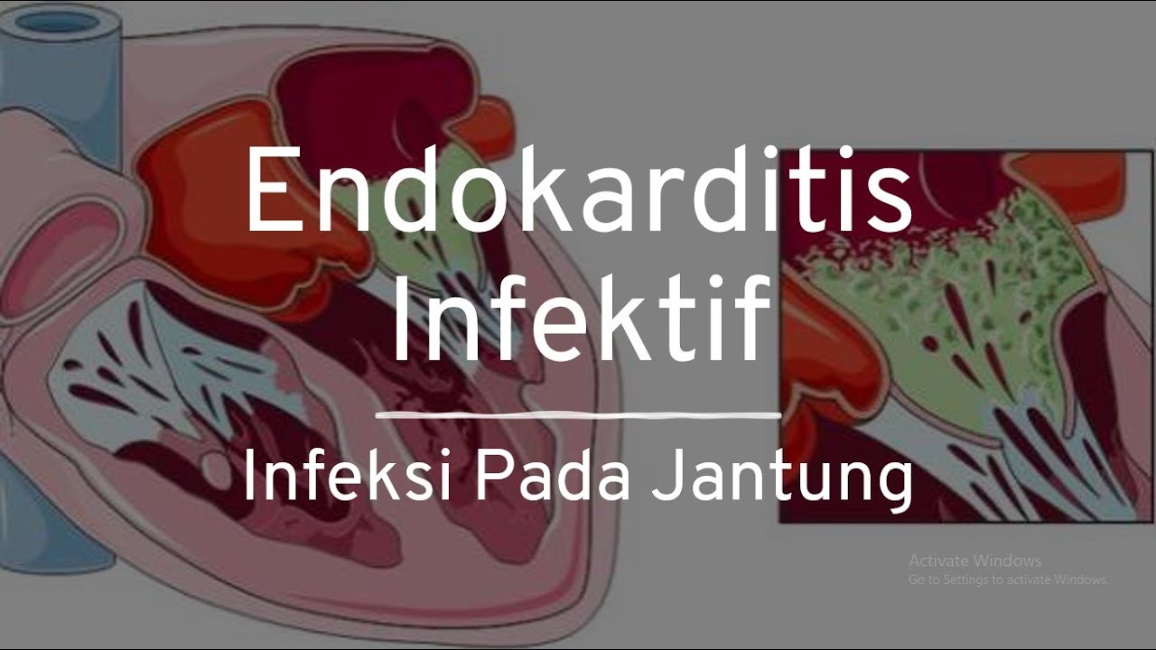 Infeksi Pada Jantung (Endokarditis Infektif) - YouTube