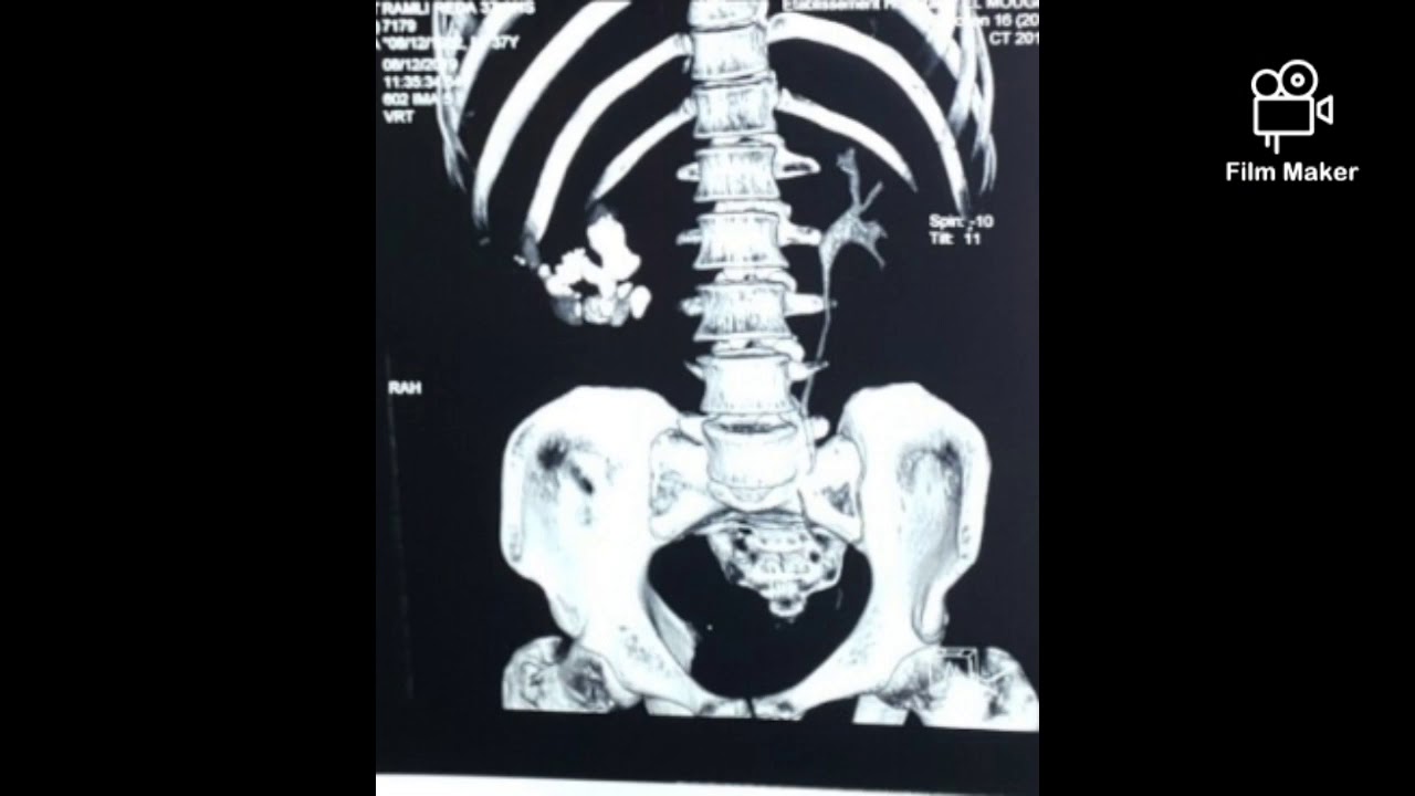 Mini NLPC dans le traitement d'une lithiase rénale coralliforme - YouTube