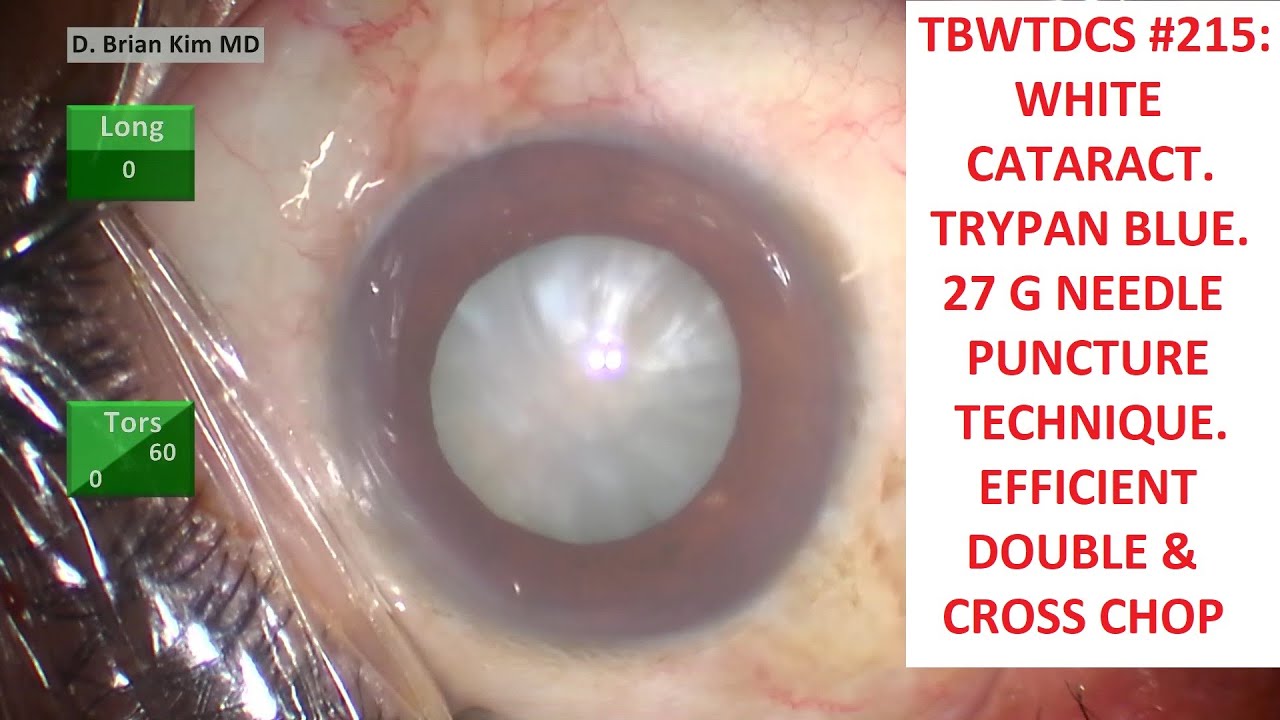 TBWTDCS #215: White Cataract. Trypan. 27 G Needle Puncture Technique ...