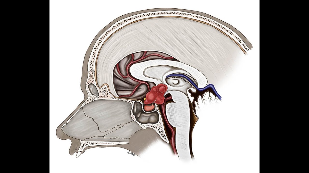 TRANSCRANIAL EXCISION OF CRANIOPHARYNGIOMA - YouTube
