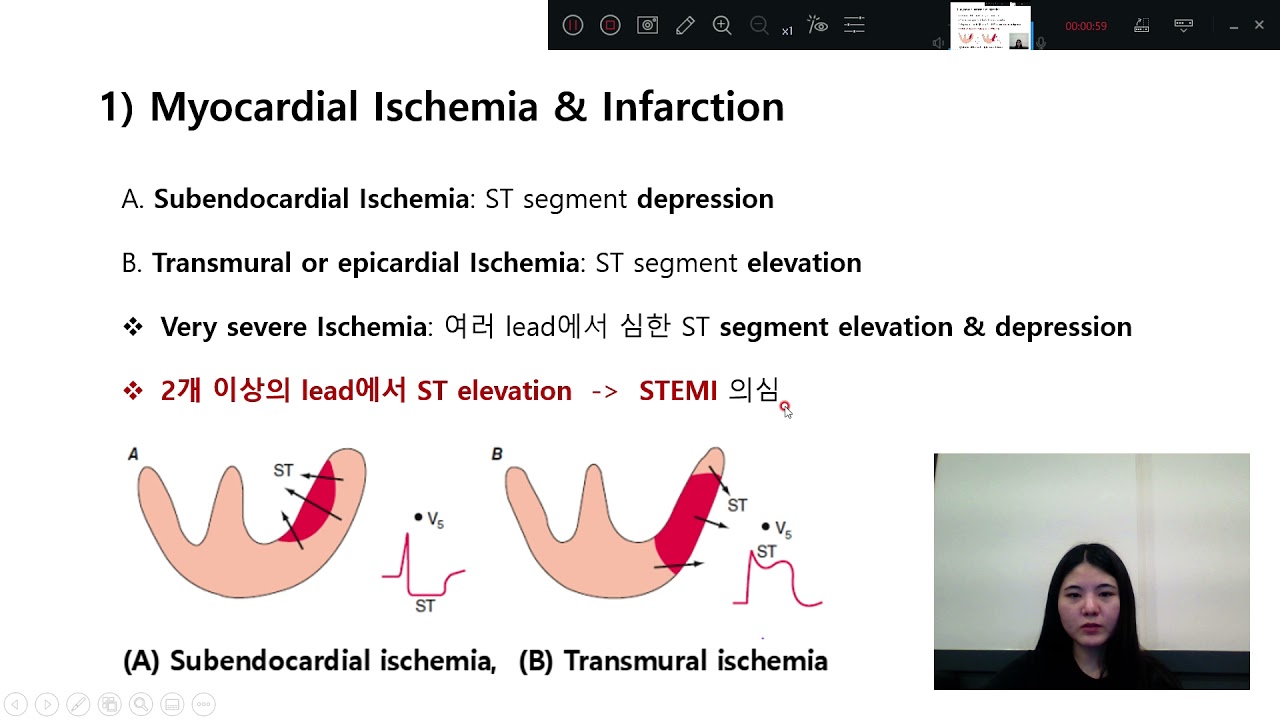 2021 9조 STEMI에서 ECG에서의 Localization, 병변 관상동맥 위치 by 유지혜 - YouTube