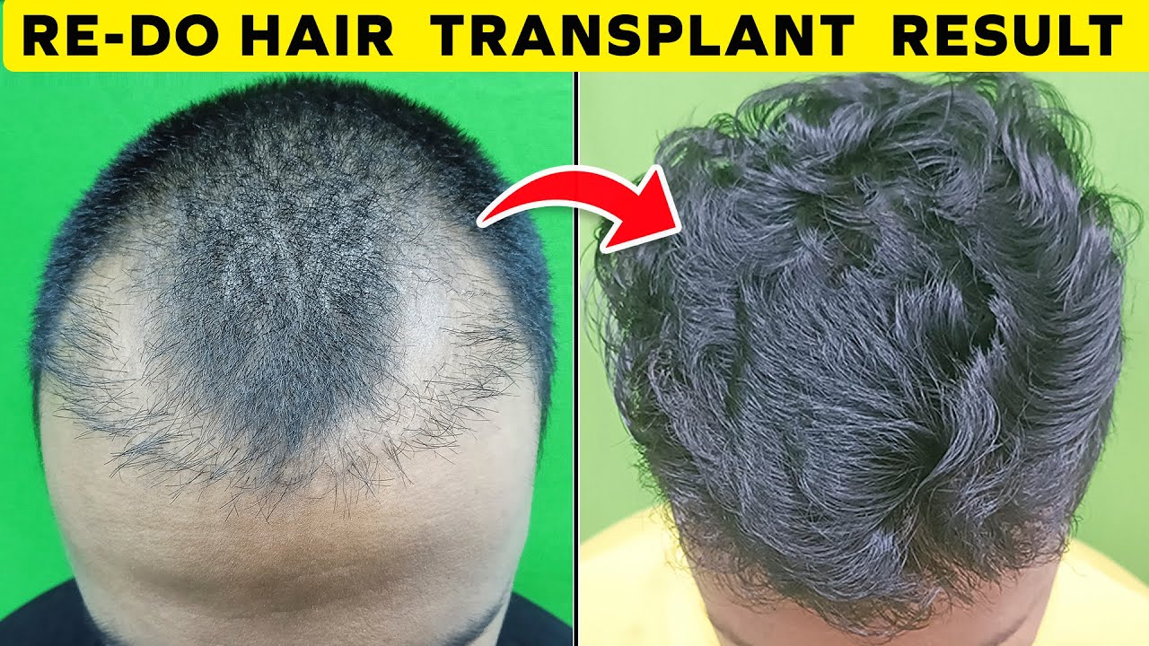 Corrective Hair Transplant | Redo Hair Transplant | Repair Hair ...