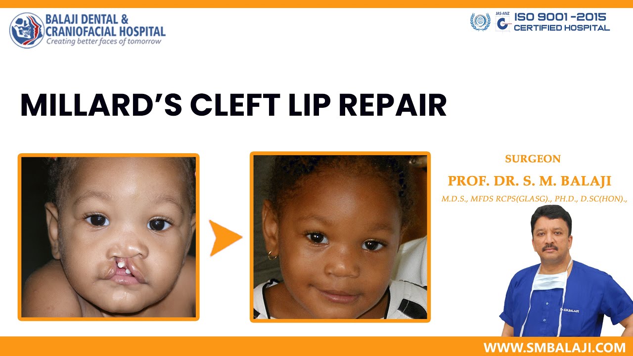 मिलार्ड्स कटे ओंठ मरम्मत। | Millard’s Cleft Lip Repair | Dr. SM Balaji ...