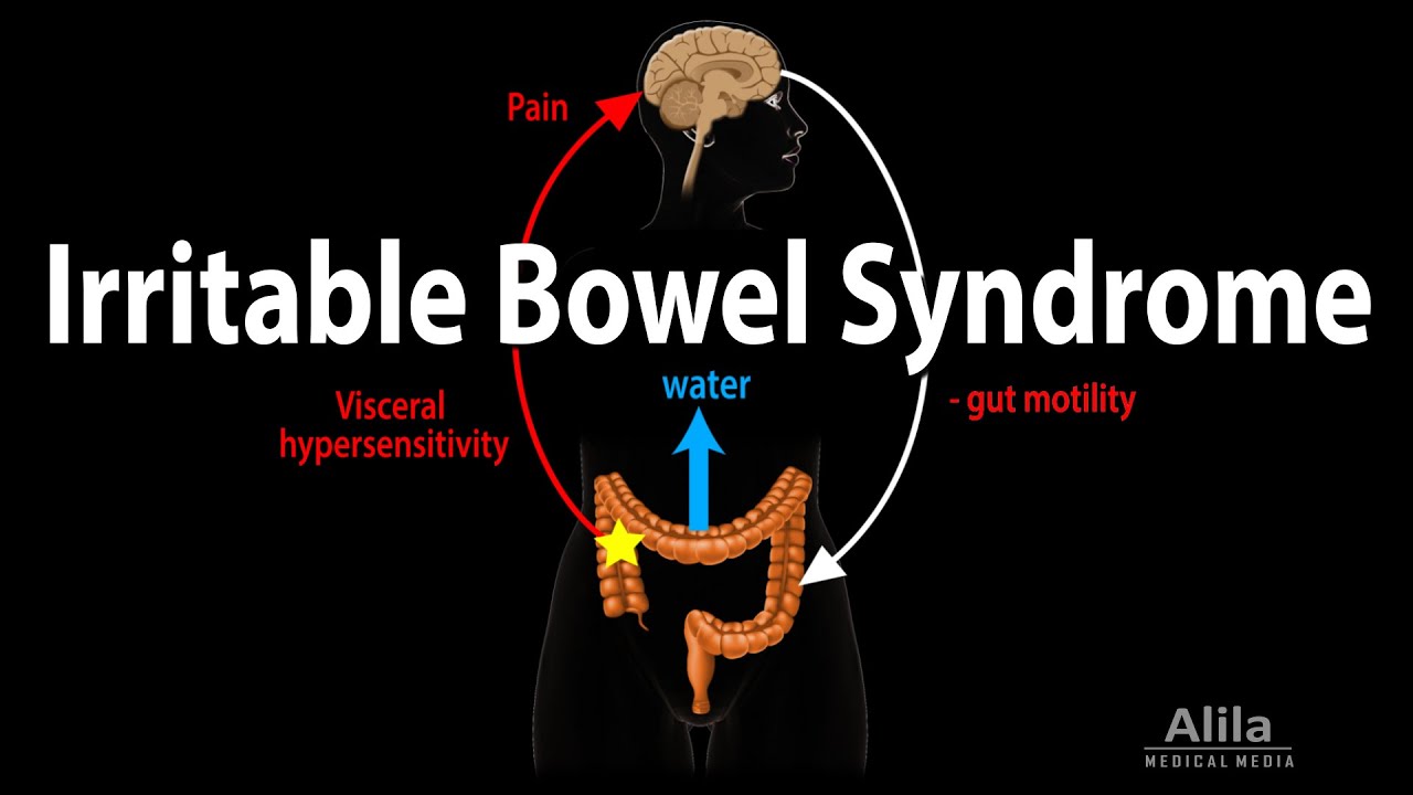 Irritable Bowel Syndrome Pathophysiology Symptoms Causes Diagnosis