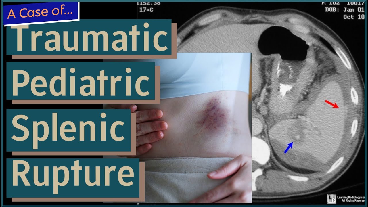 Splenic Rupture - YouTube