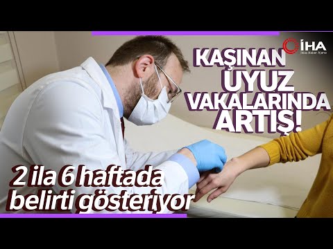 Uyuz Hastalığı Nasıl Bulaşır, Uyuz Hastalığı Tedavisi Nedir?
