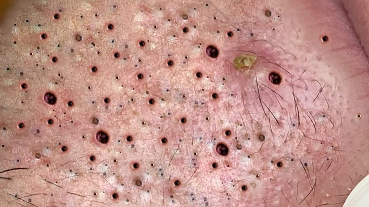 𝐄𝐱𝐭𝐫𝐞𝐦𝐞 𝐁𝐥𝐚𝐜𝐤𝐡𝐞𝐚𝐝 𝐑𝐞𝐦𝐨𝐯𝐚𝐥 𝐚𝐭 𝐋𝐍𝐆 𝐒𝐤𝐢𝐧 𝐂𝐚𝐫𝐞 # 58542 - YouTube