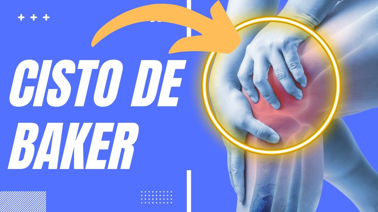 Cisto de Baker - Dor atrás do joelho - Causas e tratamentos - YouTube