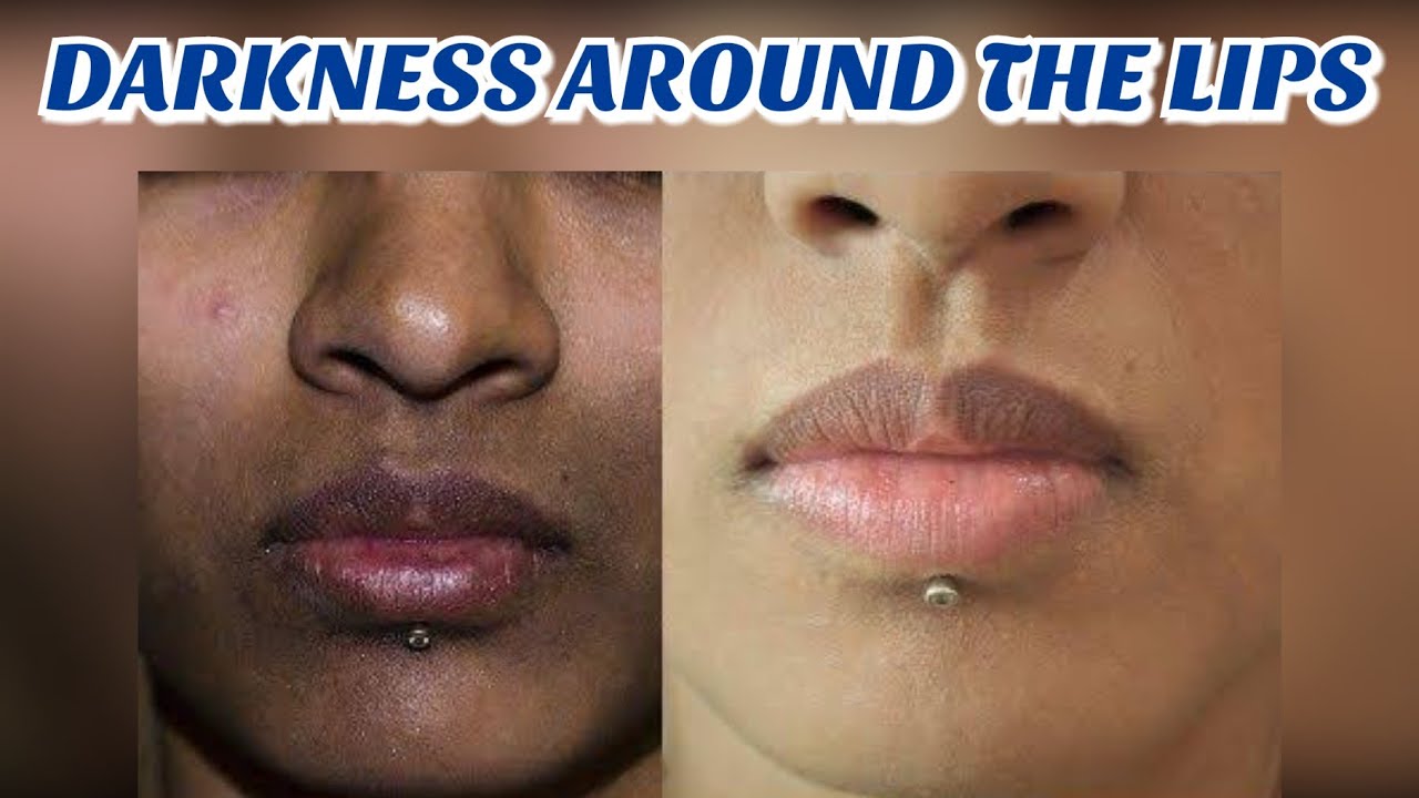 How to treat darkness around lips | pimples around lips | uper lips ...