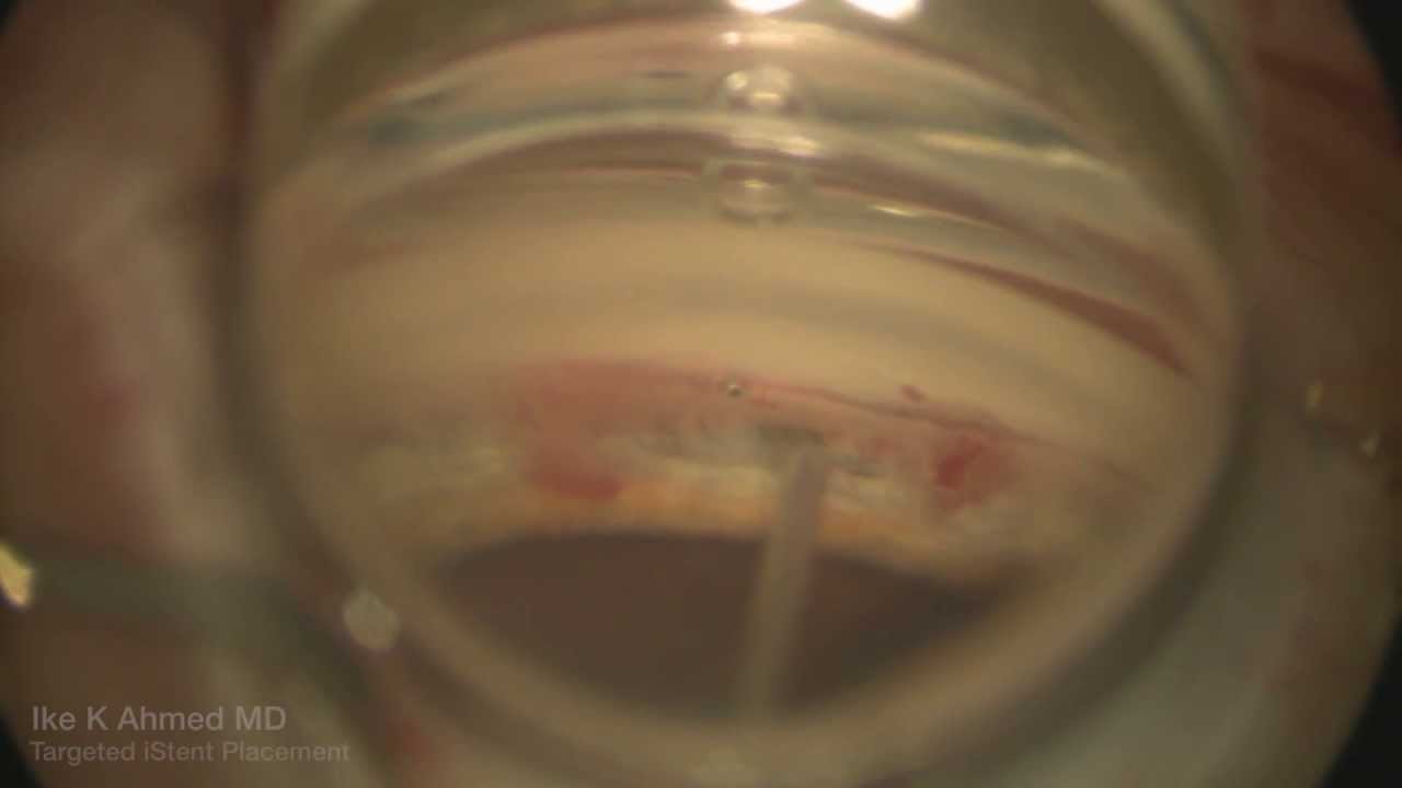 Microinvasive Glaucoma Surgery: Adding another iStent with increased Aqueous Vein Flow AHMED ...