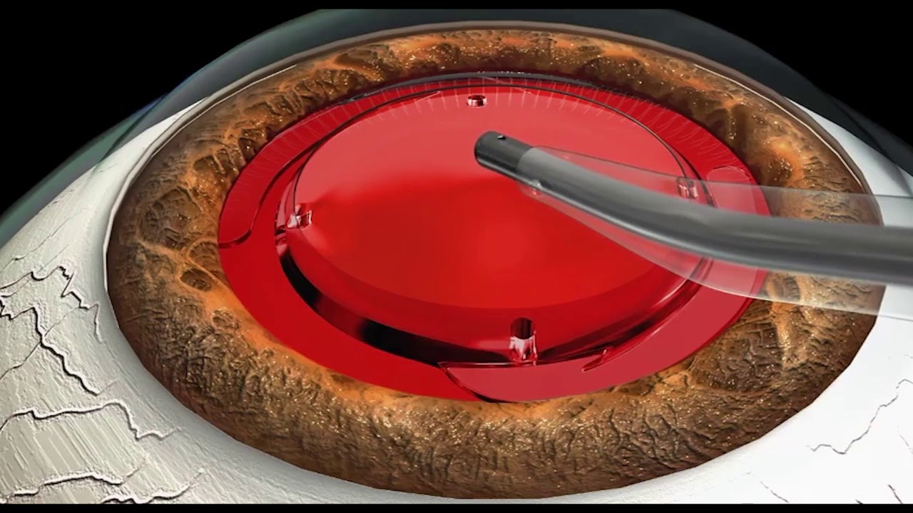 Glued Iol+Ppp - YouTube