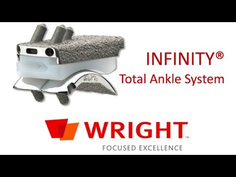 Infinity Total Ankle System (Wright) by Stryker - YouTube