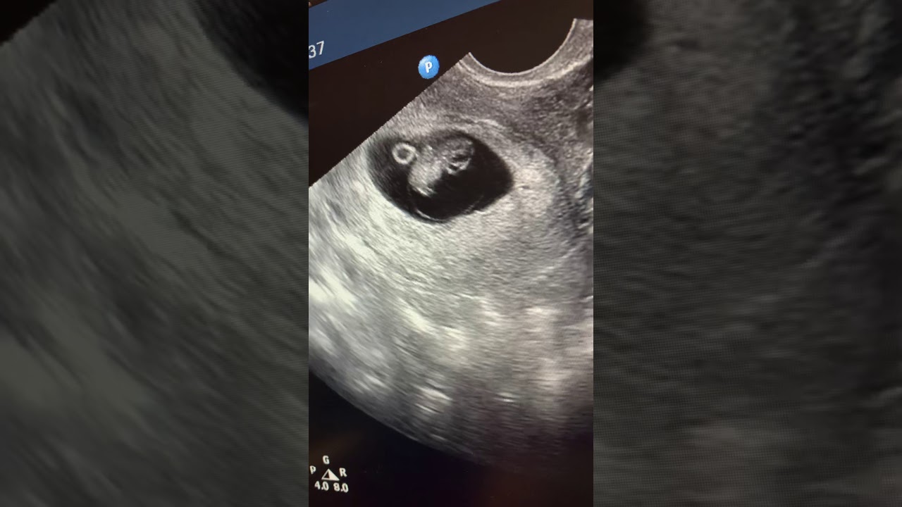 Ultrasound TransVaginal 8 weeks 5 day Fetus - YouTube