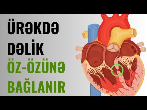 ÜRƏKDƏ DƏLİK öz-özünə bağlanır?! | Uşaq Kardioloqu Elnur İmanov