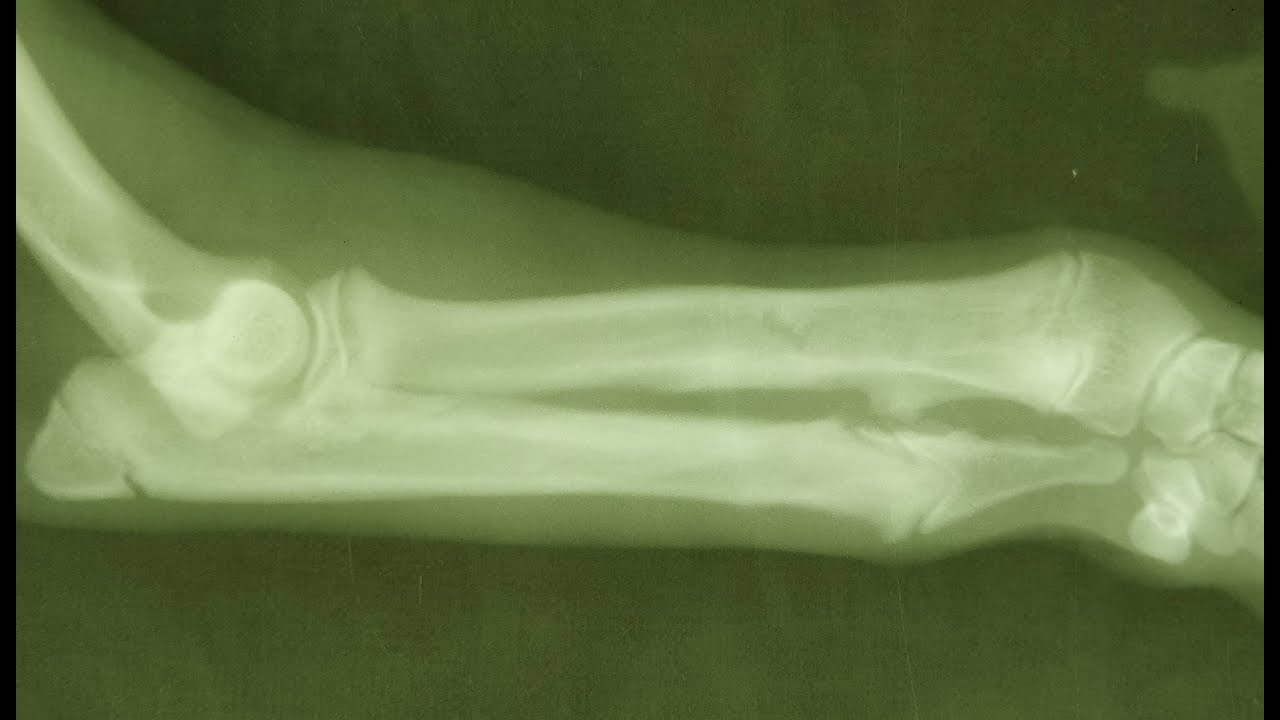 " Beauty" - X-Ray - YouTube