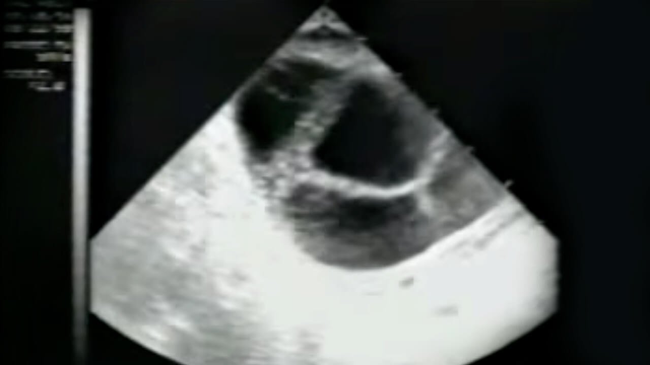 ART 1: Egg Retrieval (Infertility Treatment) - YouTube