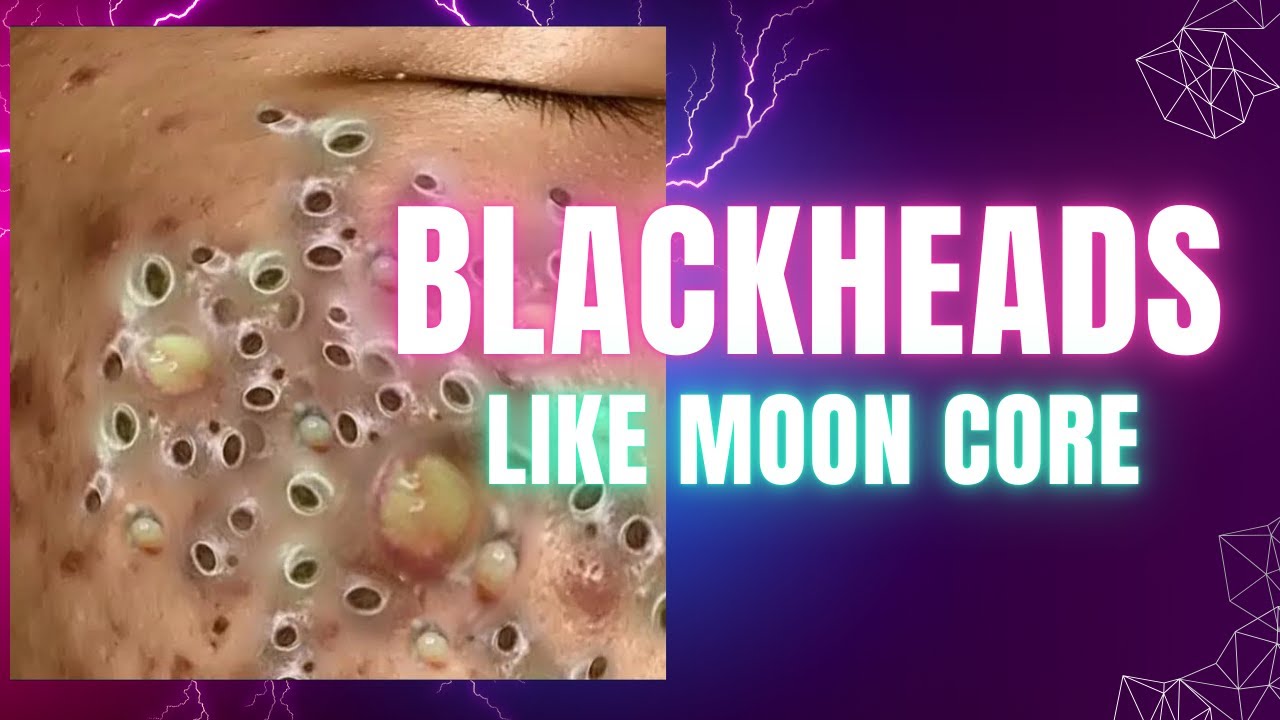 Blackheads like moon core! - YouTube