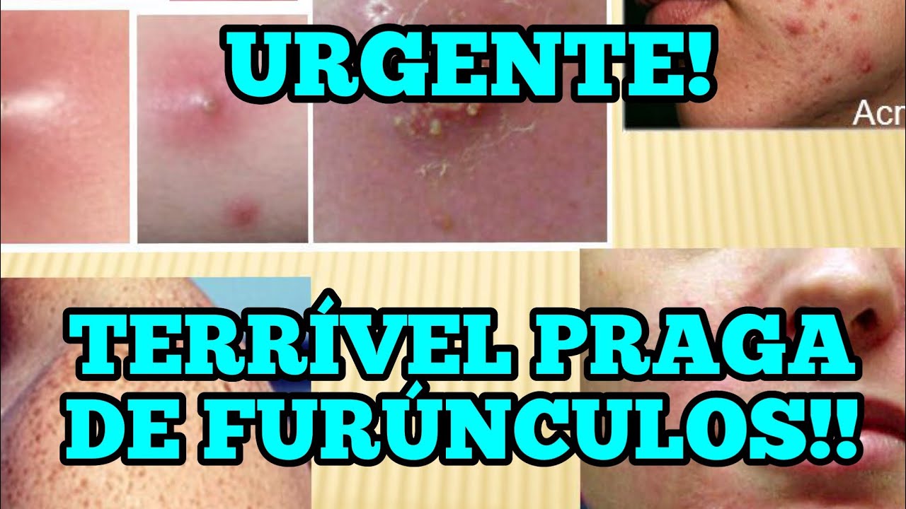Vídeos De Furúnculos Gigantes - RETOEDU
