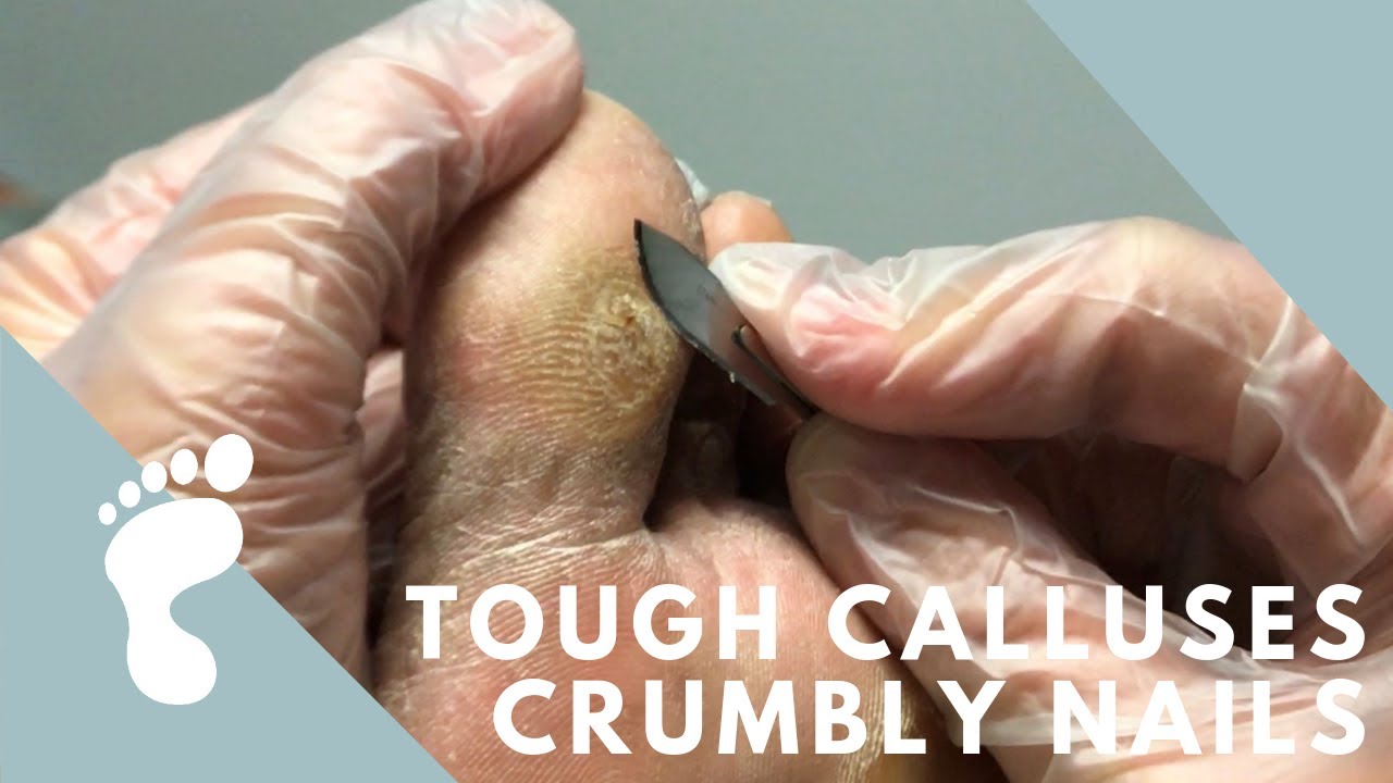 ROCK HARD CALLUSES AND CRUMBLY TOENAILS - YouTube